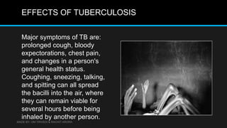 Tuberculosis | PPT