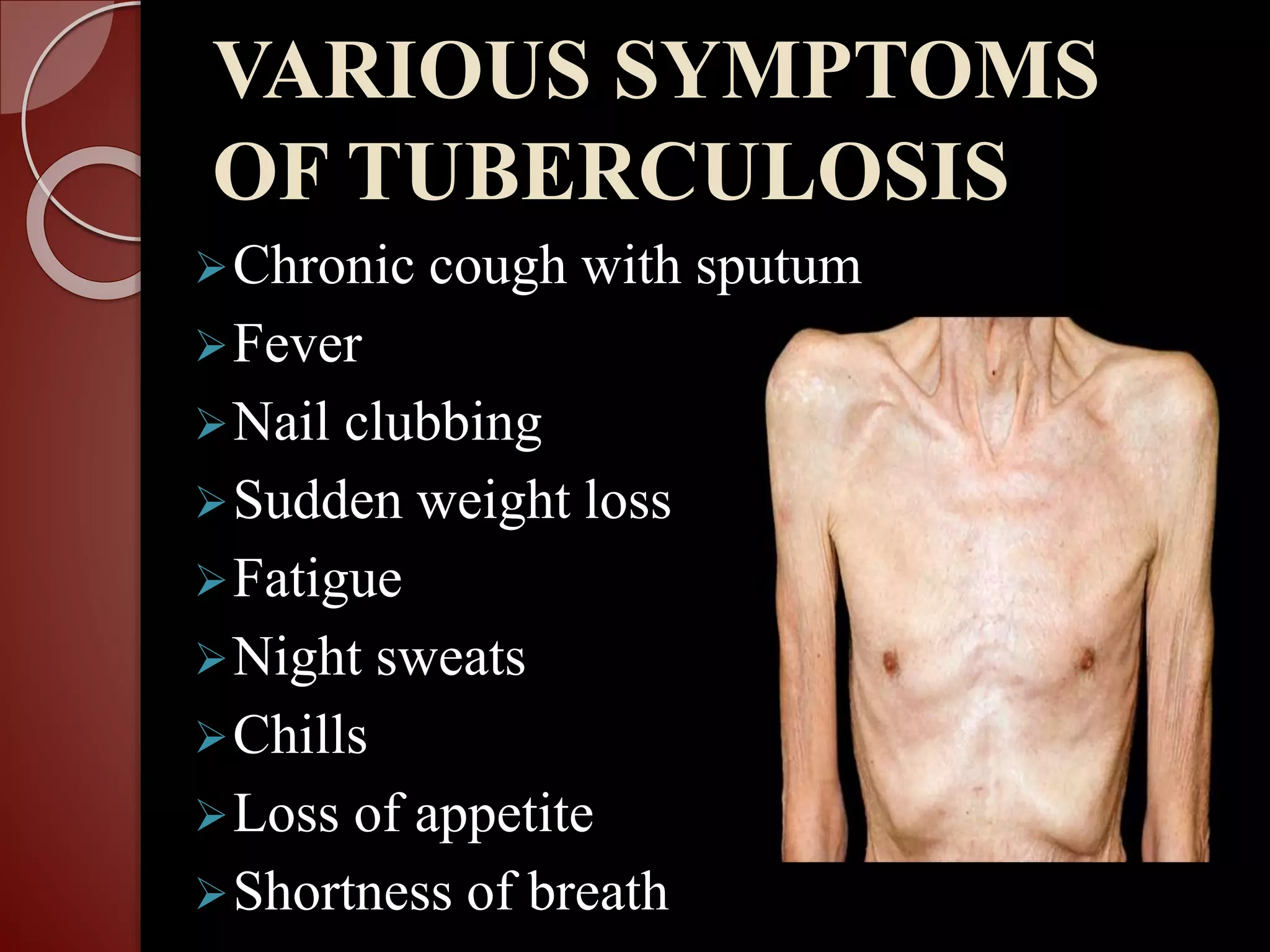 Austin Tuberculosis: Research & Treatment | PPT