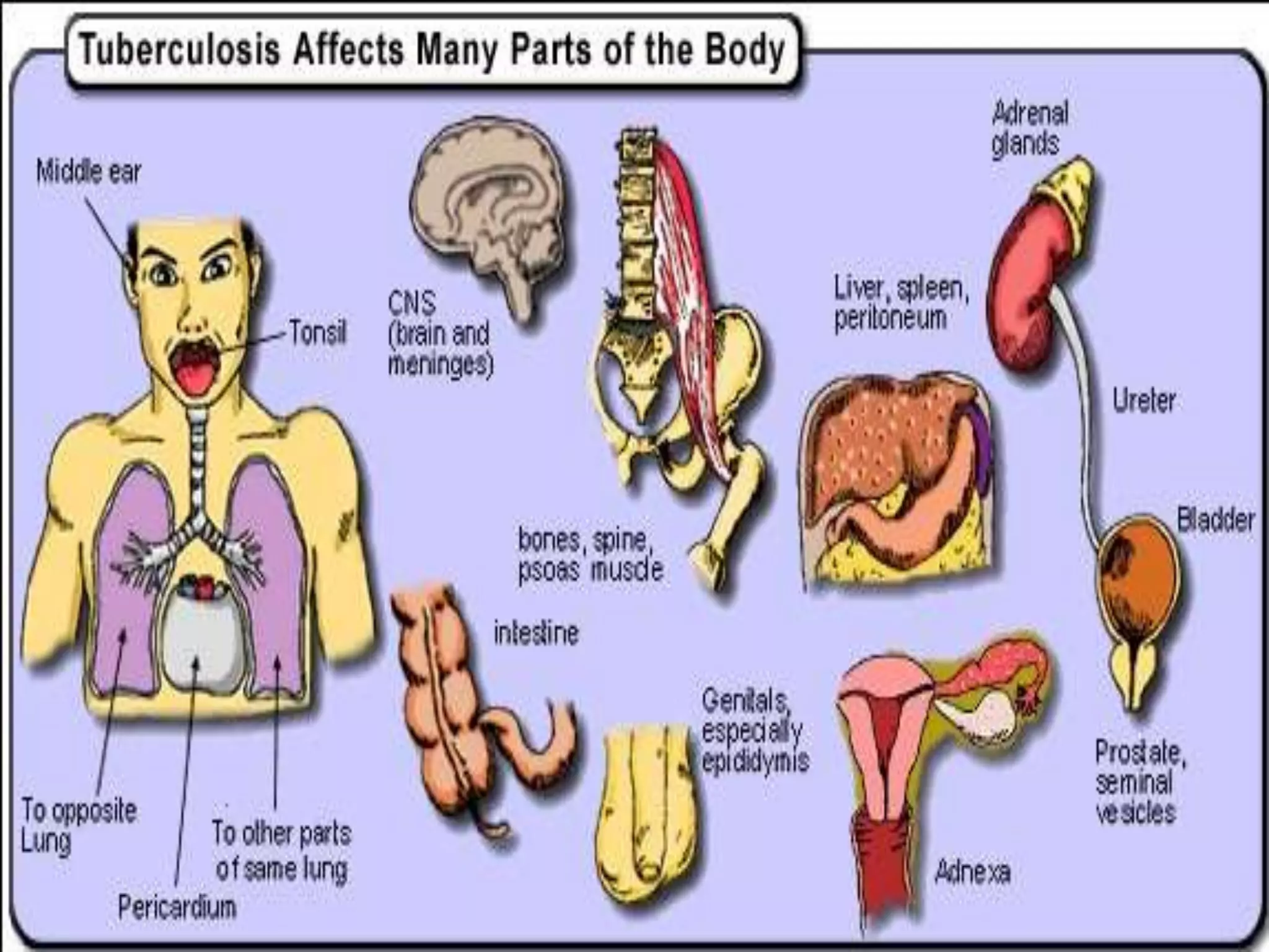 Austin Tuberculosis: Research & Treatment | PPTX | Lung and Respiratory ...