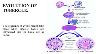 Tubercle Tuberculosis