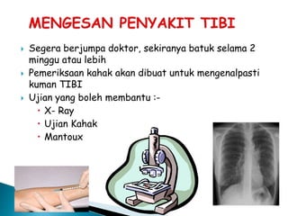 Tuberculosis slides | PPT
