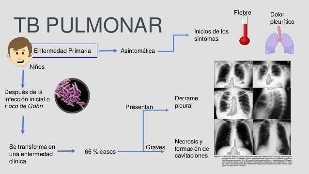 Tuberculosis Pulmonar y Extrapulmonar