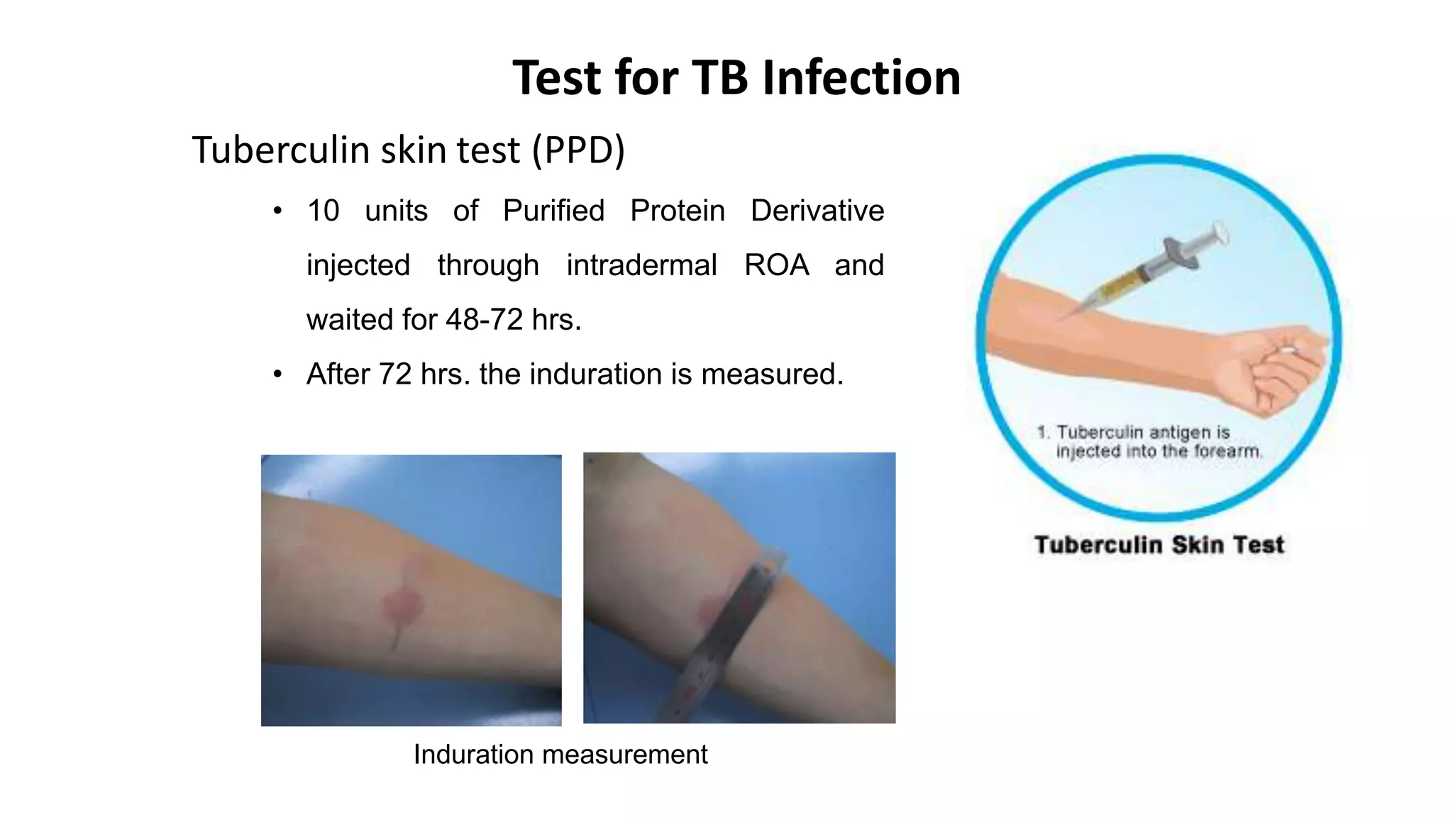 Tuberculosis with a case presentation | PPTX