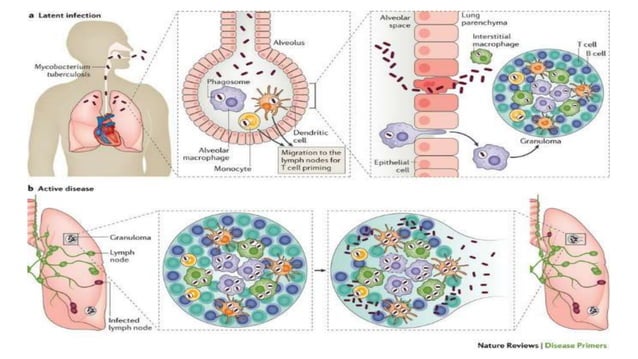 Tuberculosis with a case presentation | PPTX