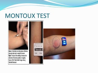 Tuberculosis | PPTX