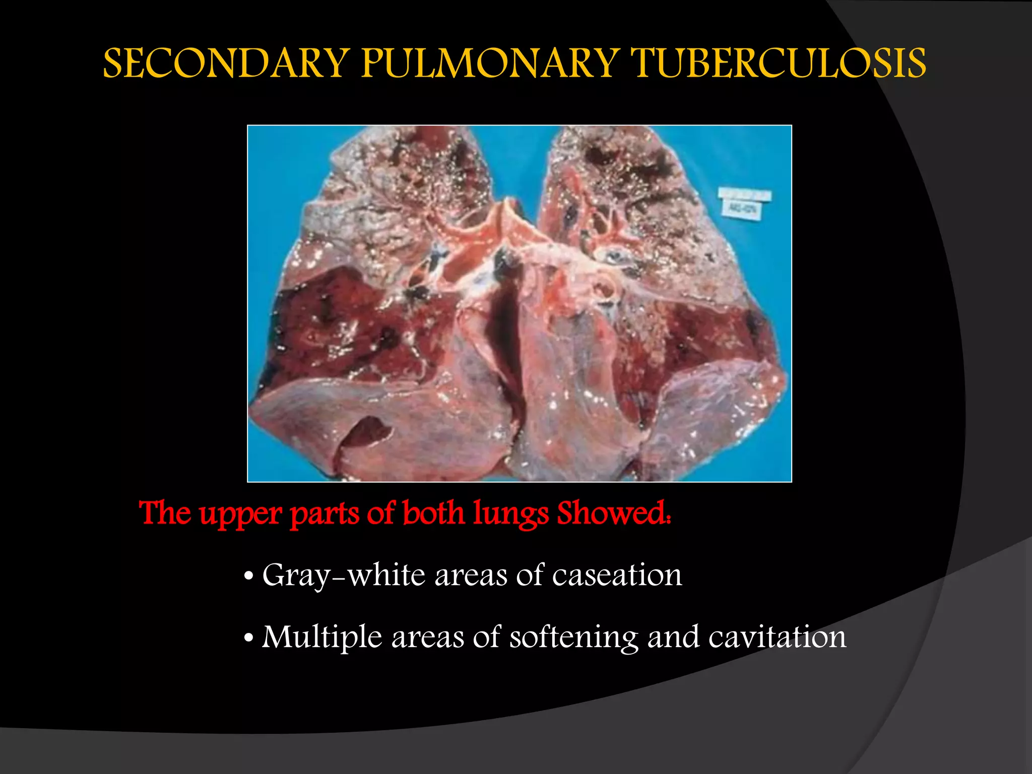 Tuberculosis | PPTX