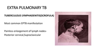 Tuberculosis | PPTX