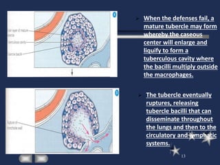 Tuberculosis | PPT