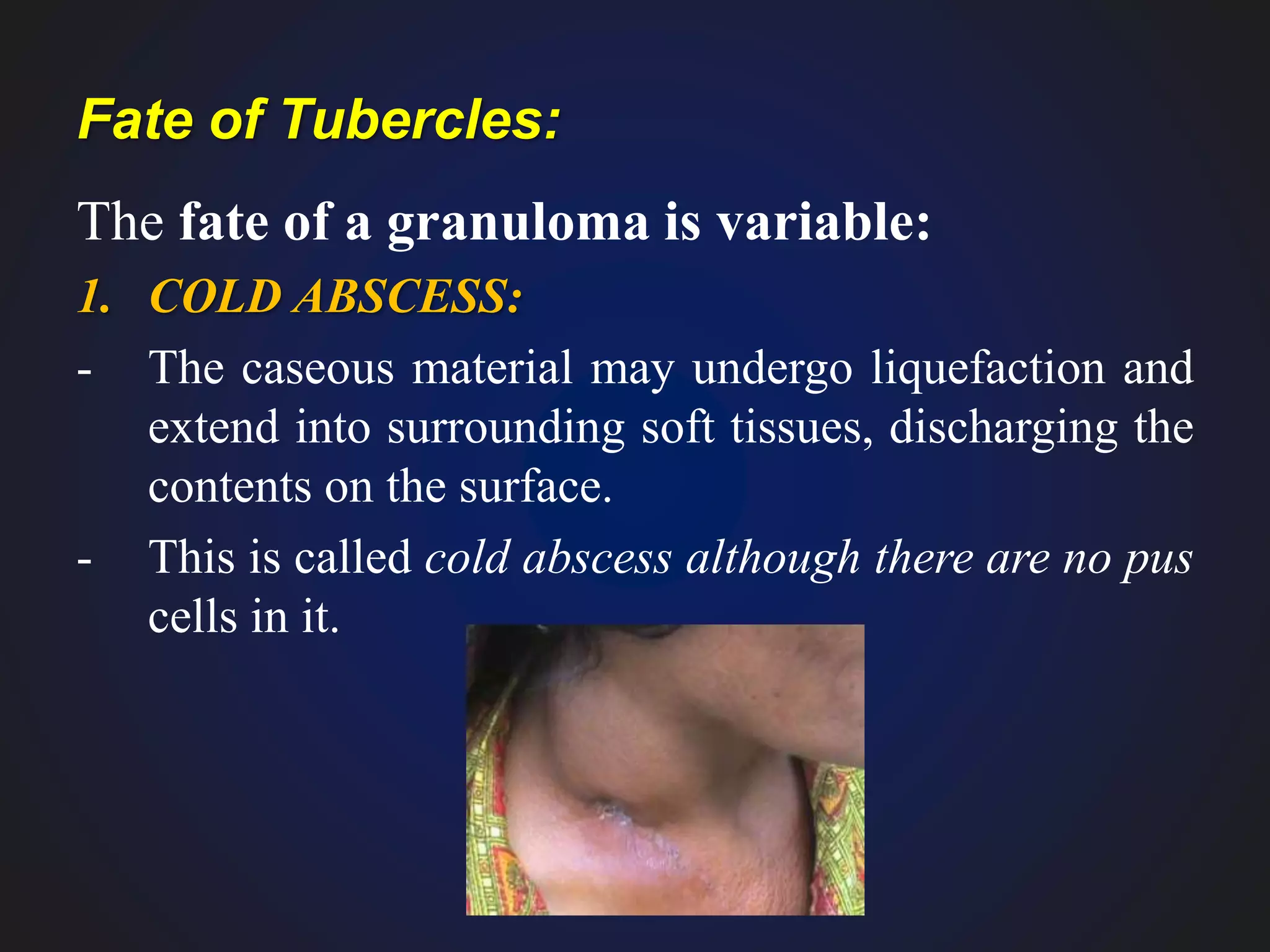 Tuberculosis | PPSX