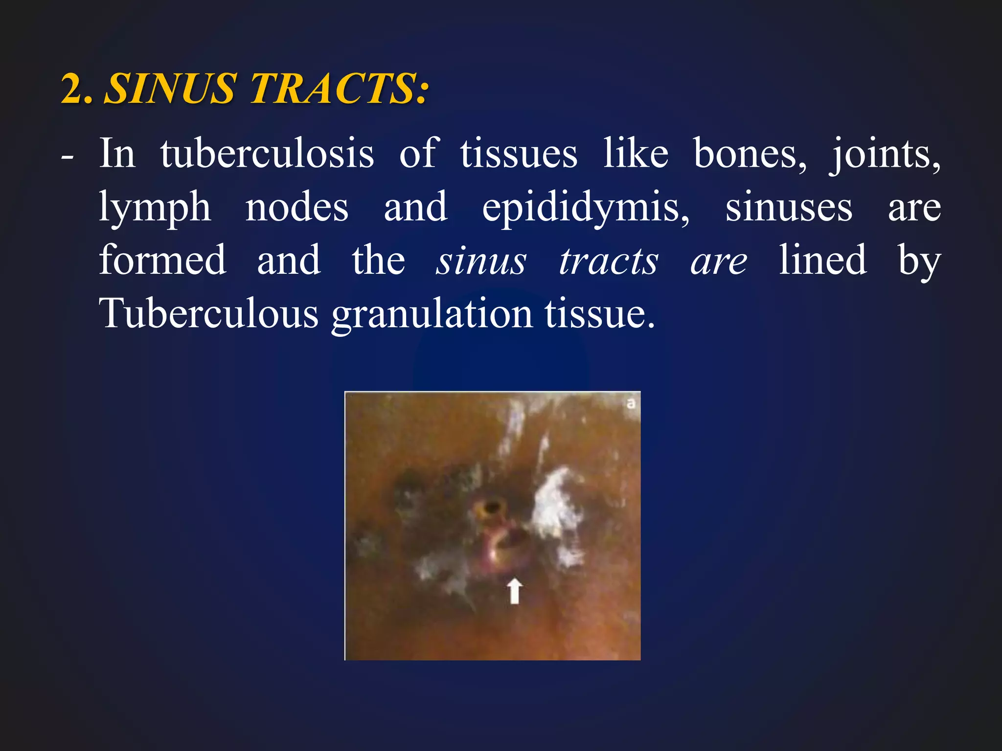 Tuberculosis | PPSX