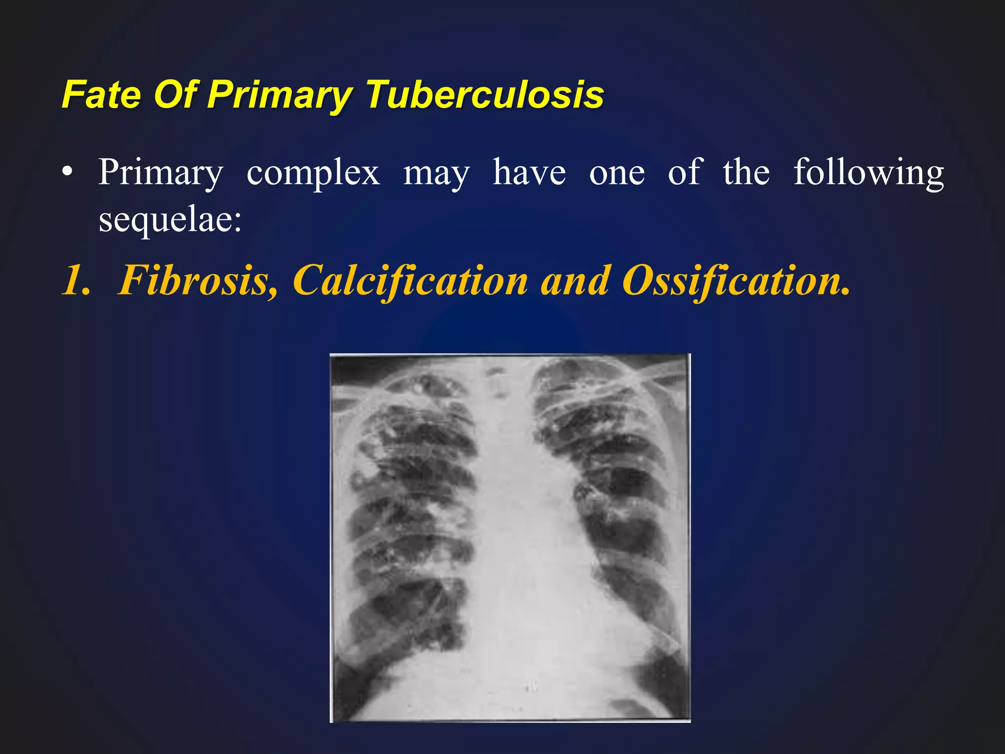 Tuberculosis | PPSX