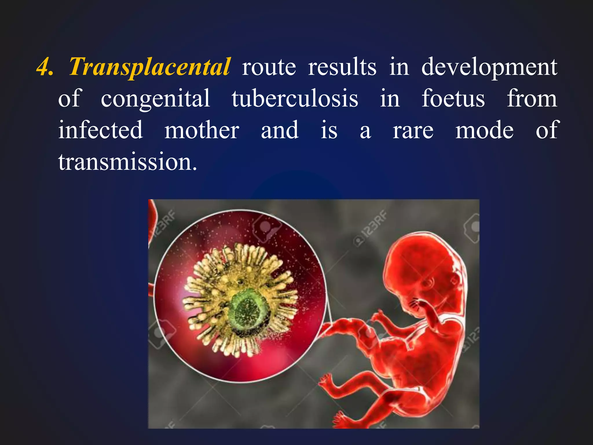 Tuberculosis | PPTX