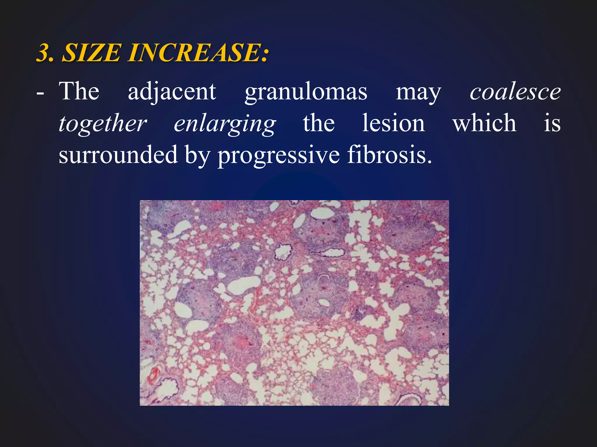 Tuberculosis | PPTX