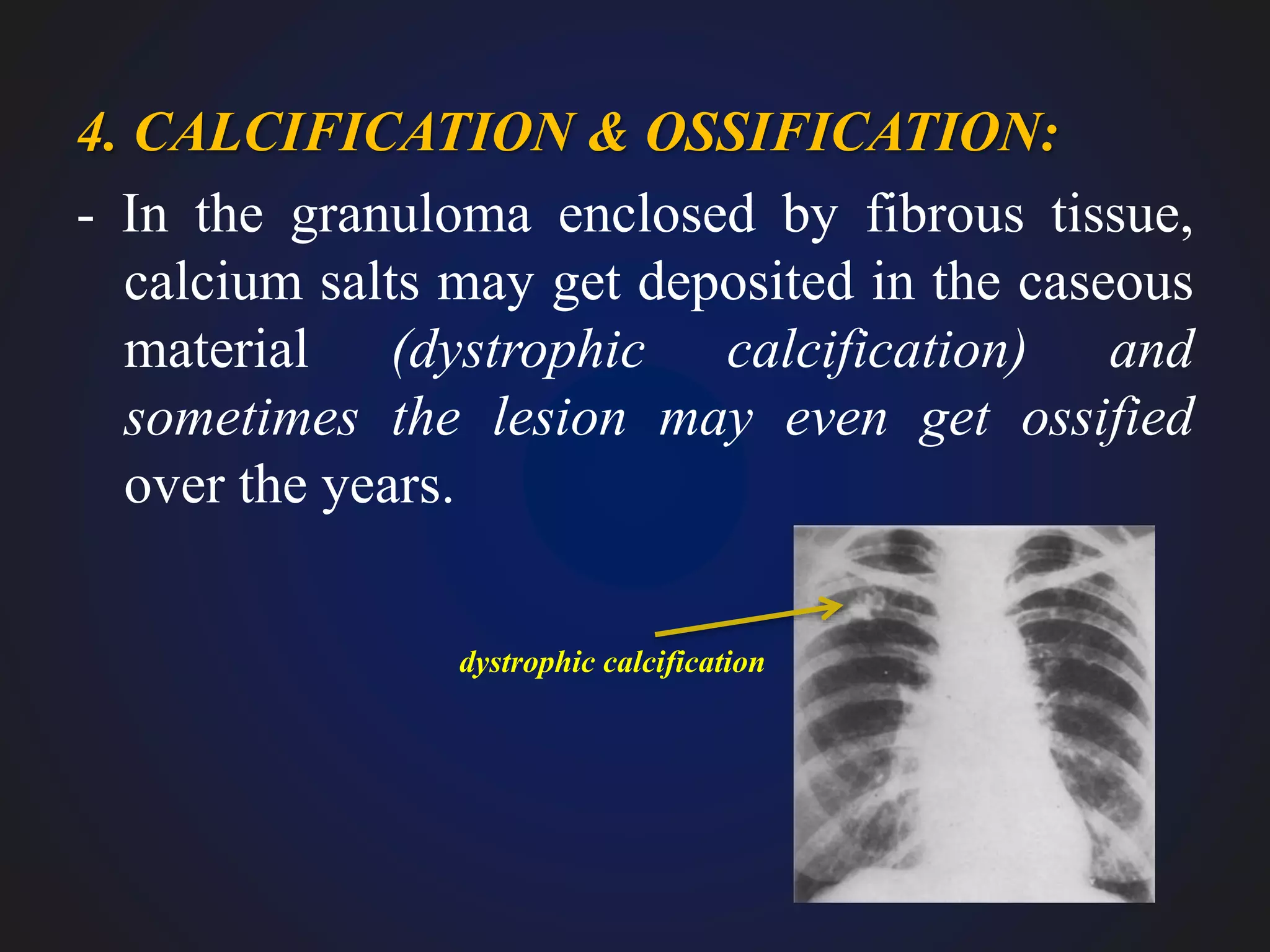 Tuberculosis | PPTX
