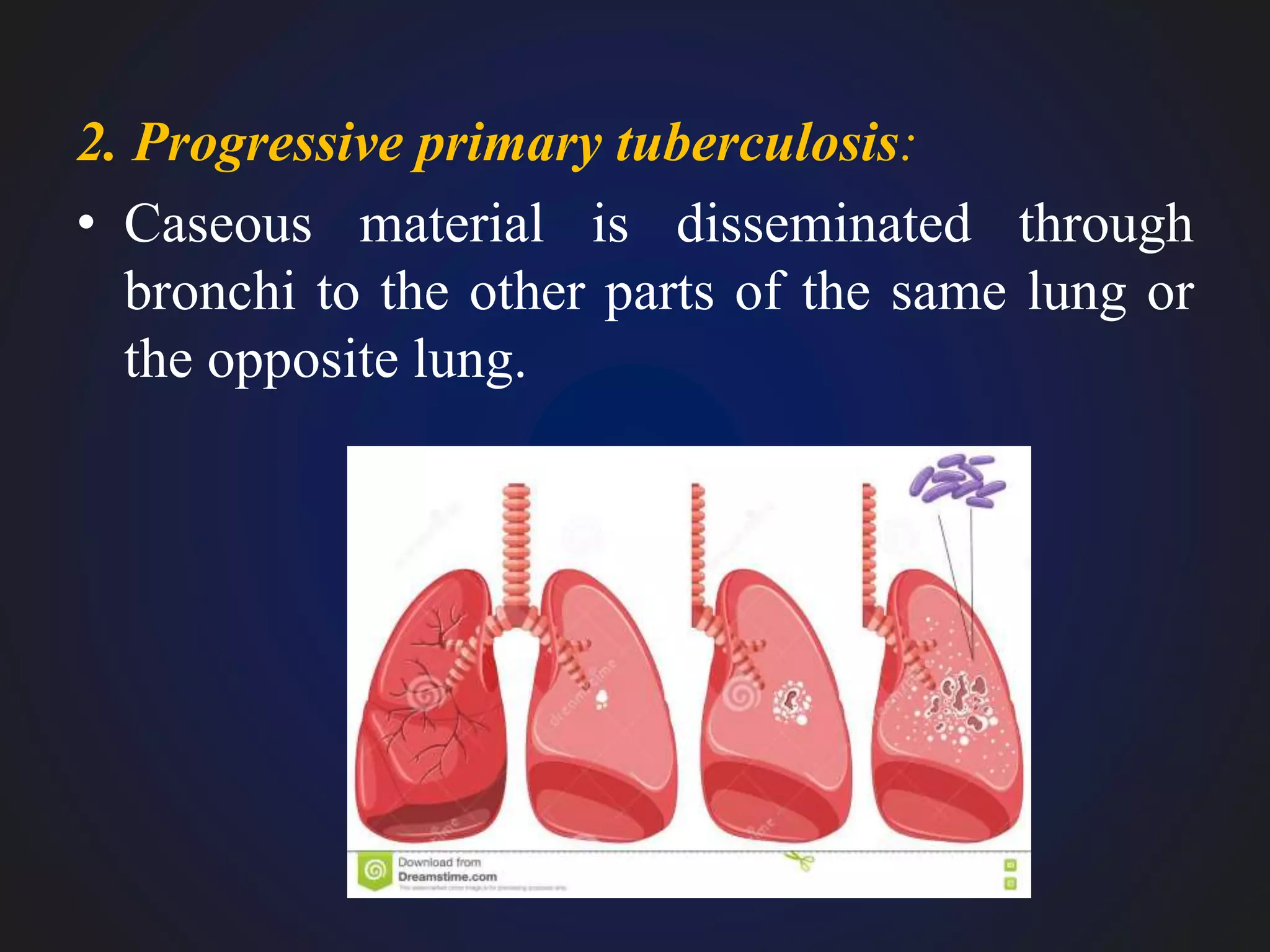 Tuberculosis | PPTX