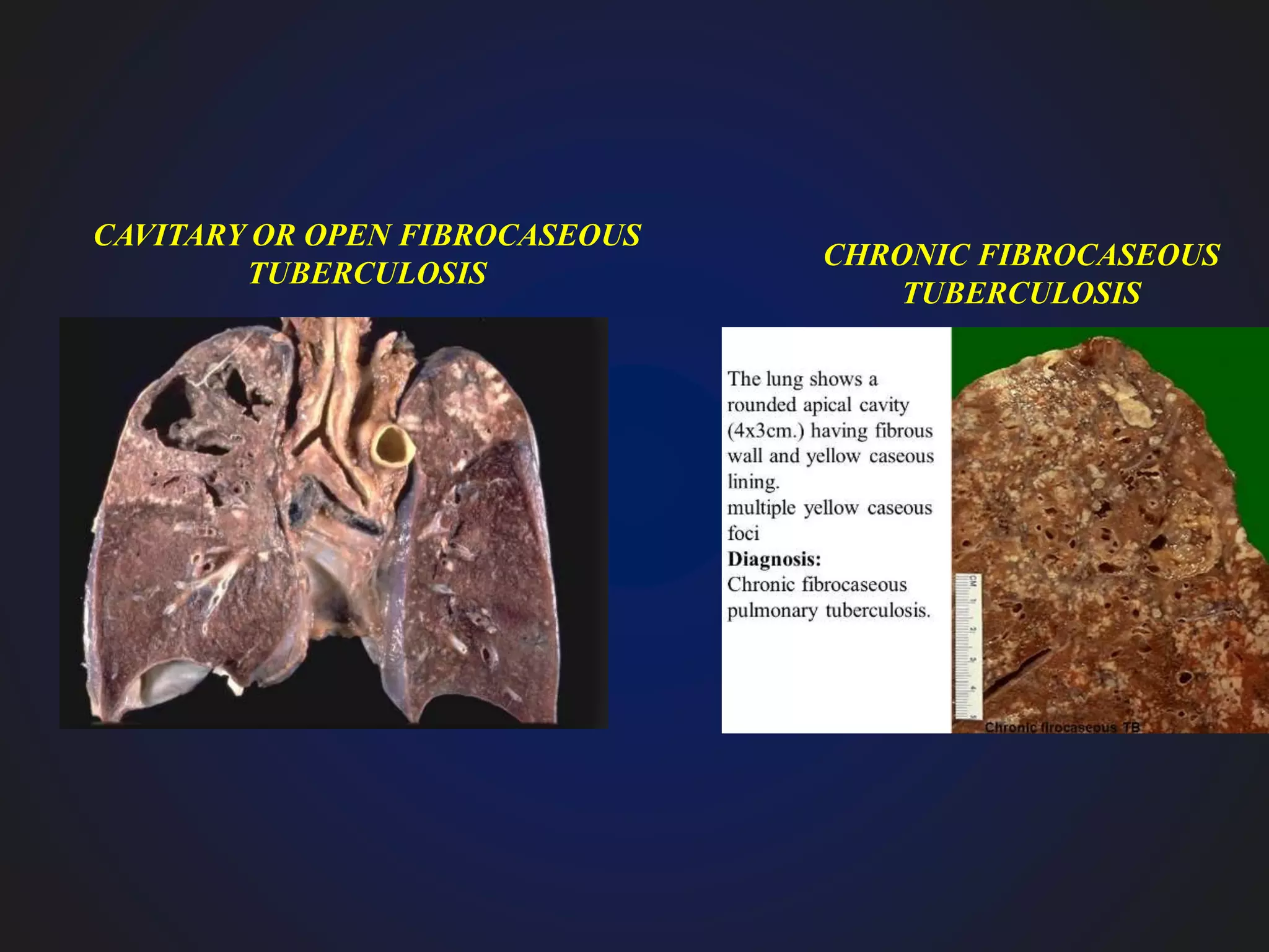 Tuberculosis | PPTX