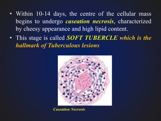 Tuberculosis | PPTX