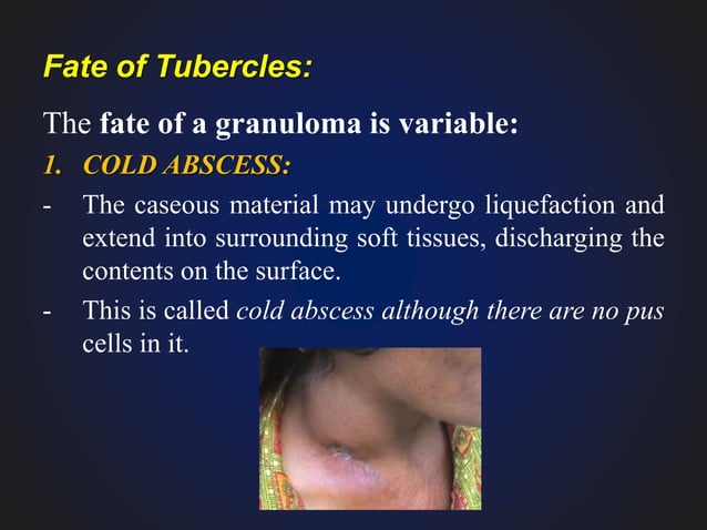 Tuberculosis | PPTX | Lung and Respiratory Health | Diseases and Conditions
