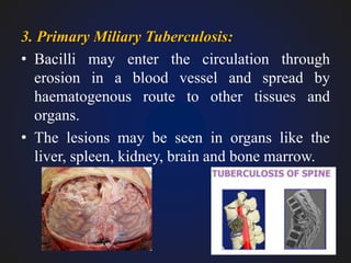 Tuberculosis | PPTX