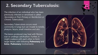 Tuberculosis | PPTX