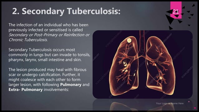 Tuberculosis | PPT
