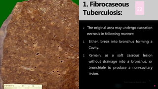 Tuberculosis | PPT