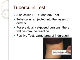 Tuberculosis | PPTX