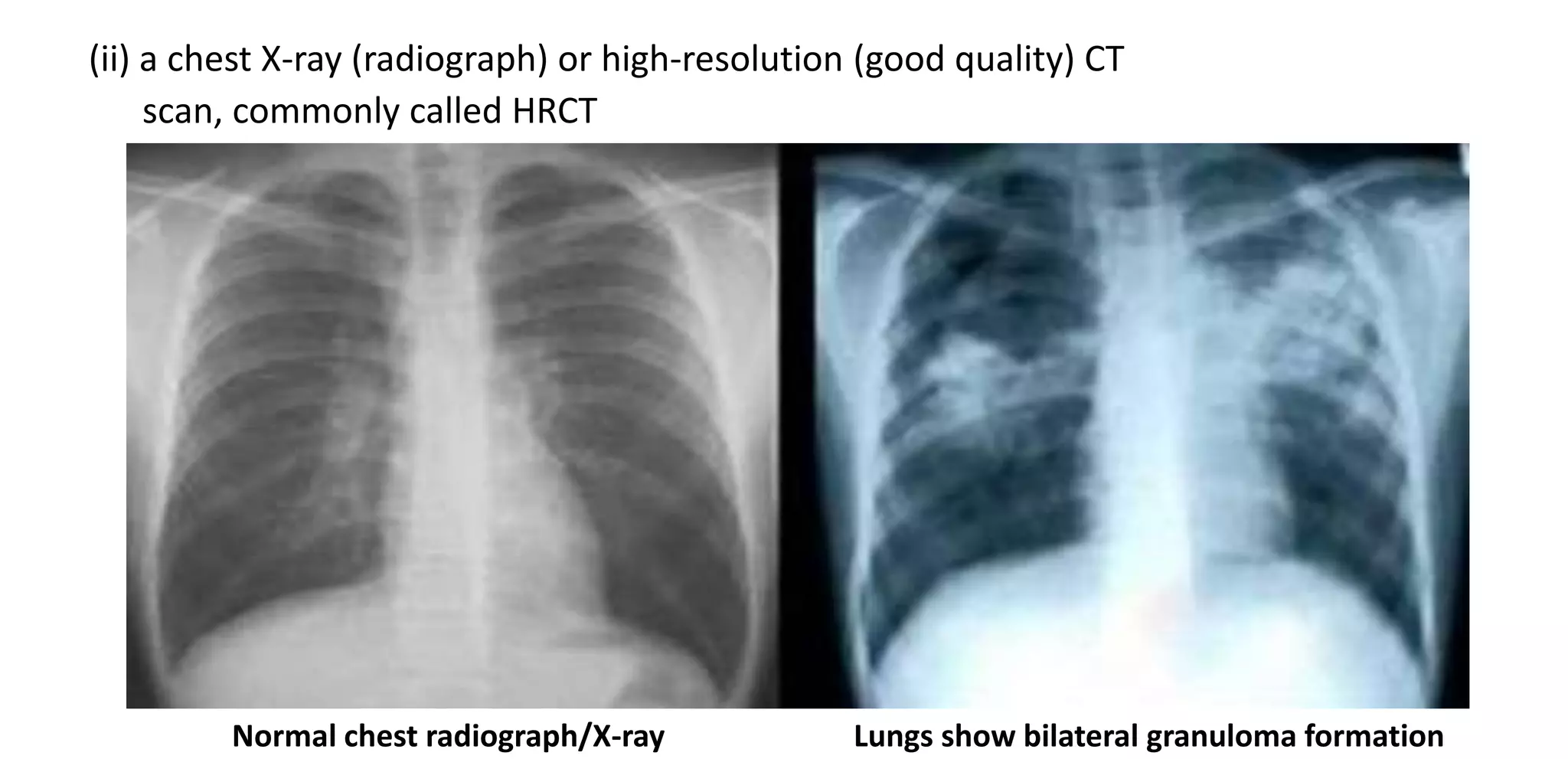 Tuberculosis | PPTX