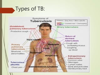 Tuberculosis.man