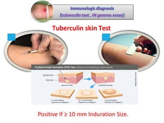 Tuberculosis | PDF