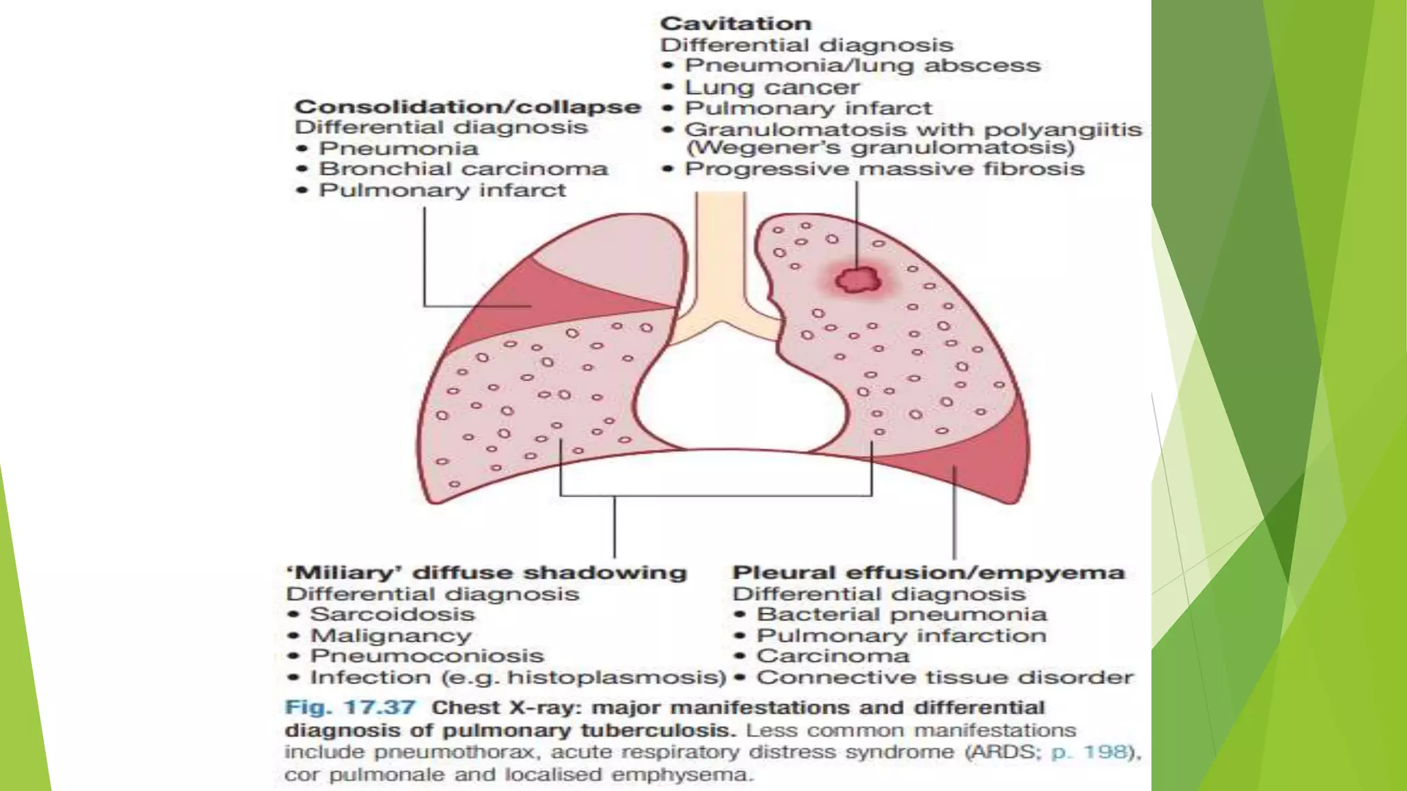 Pulmonary Tuberculosis.pptx