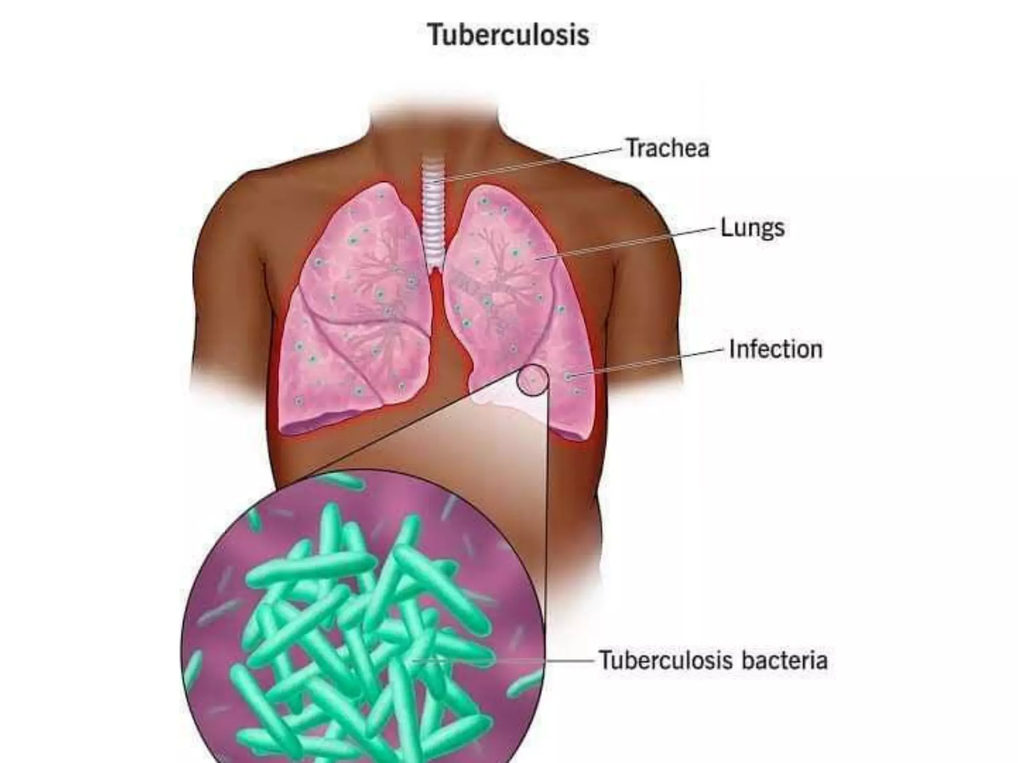 tuberculosis.pptx