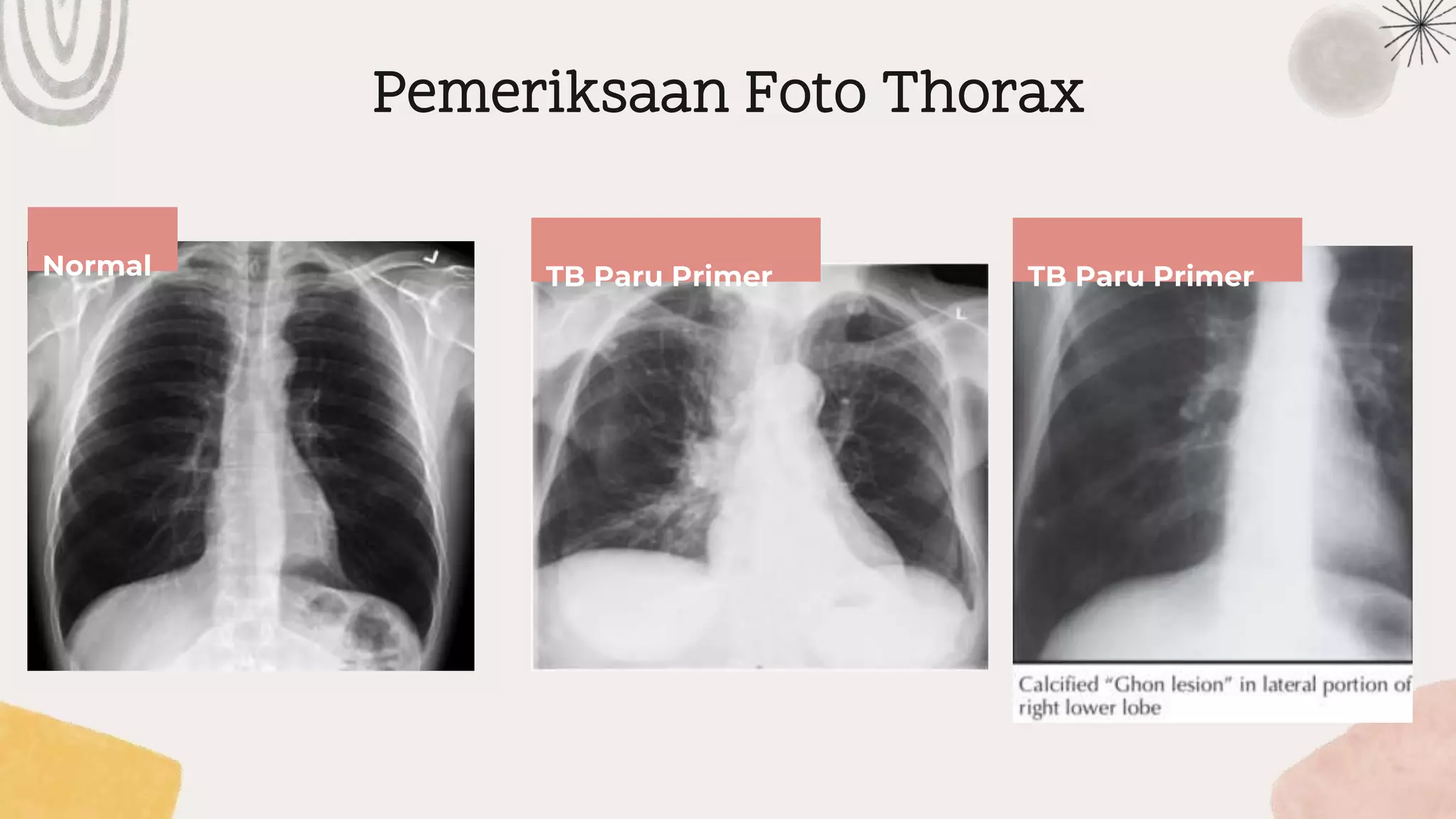 Tuberculosis.pptx