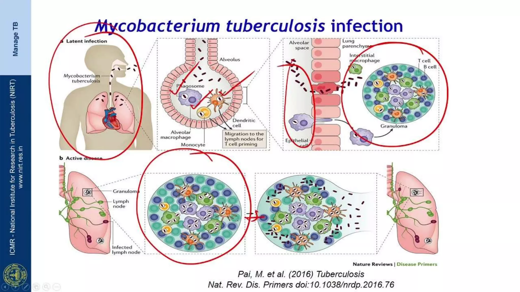 Tuberculosis.pptx | Lung and Respiratory Health | Diseases and Conditions