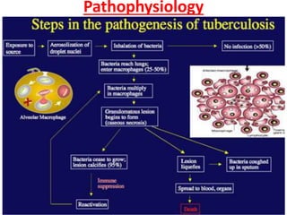 Tuberculosis.pptx