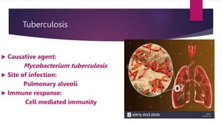 Tuberculosis,its causative agent,mode of spread,symptoms and treatment ...
