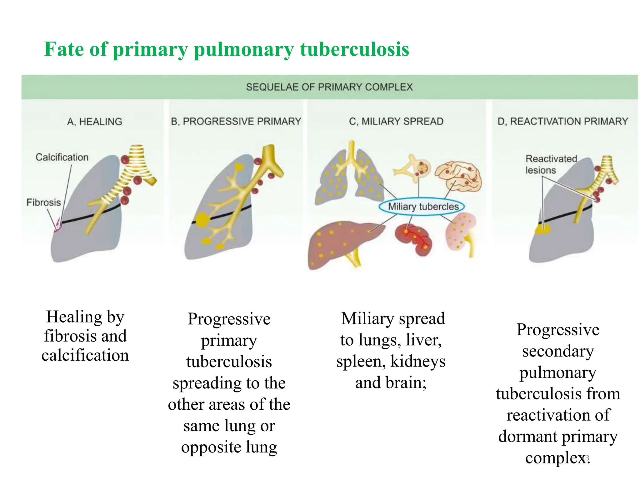 TUBERCULOSIS pharmacology notes types cure | PPTX