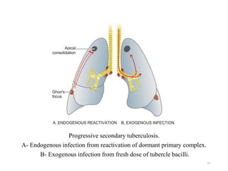 TUBERCULOSIS pharmacology notes types cure | PPTX