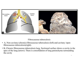 TUBERCULOSIS pharmacology notes types cure | PPTX