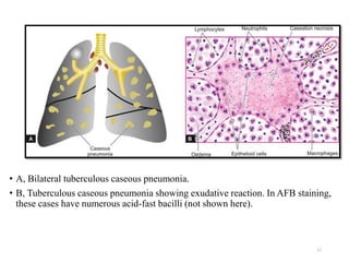 TUBERCULOSIS pharmacology notes types cure | PPTX