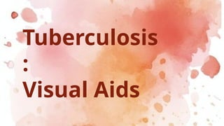 TUBERCULOSIS White Death: Presentation for Pre- Hospital Healthcare ...