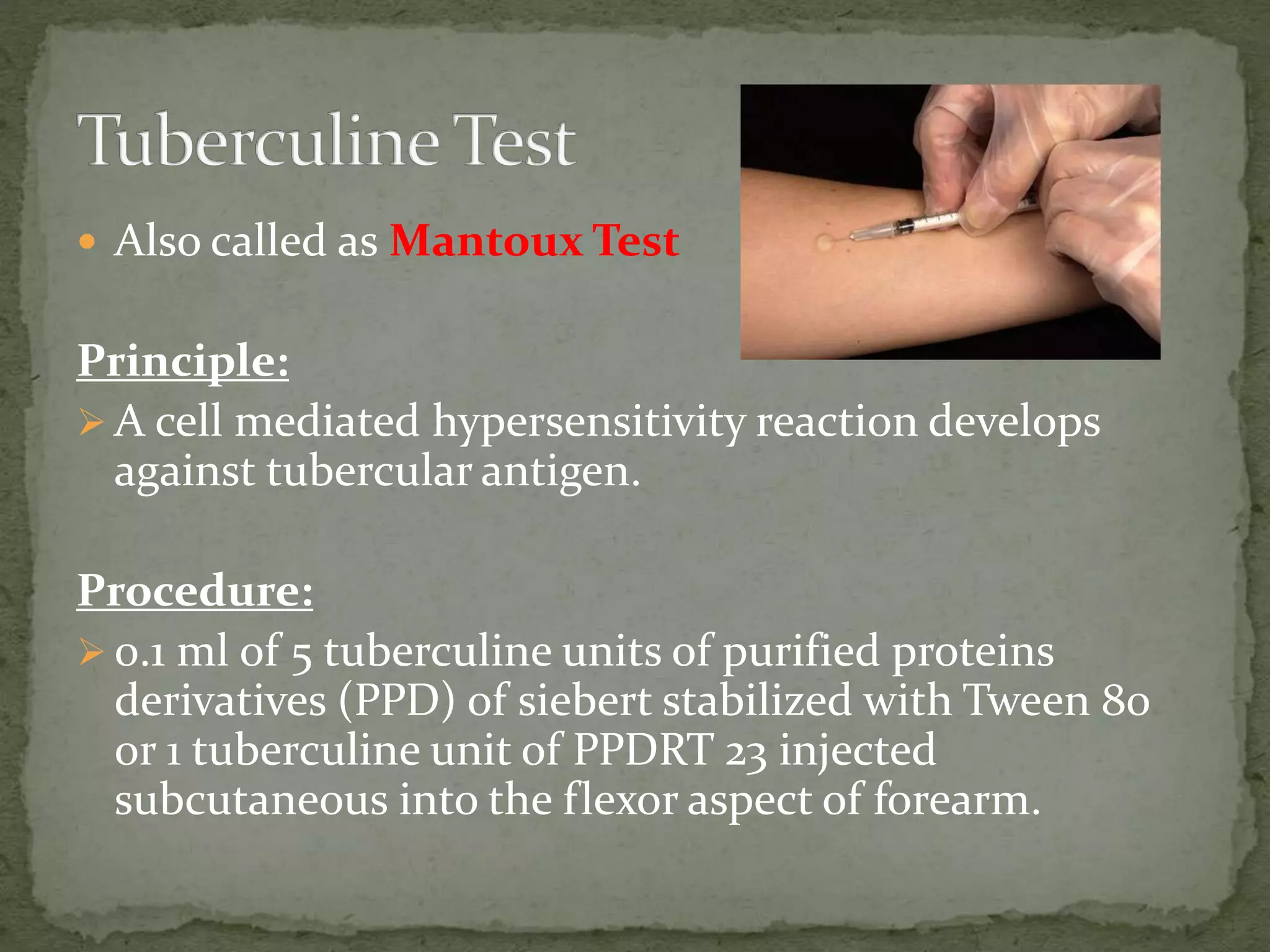 Tuberculosis- Oral Pathology | PPTX