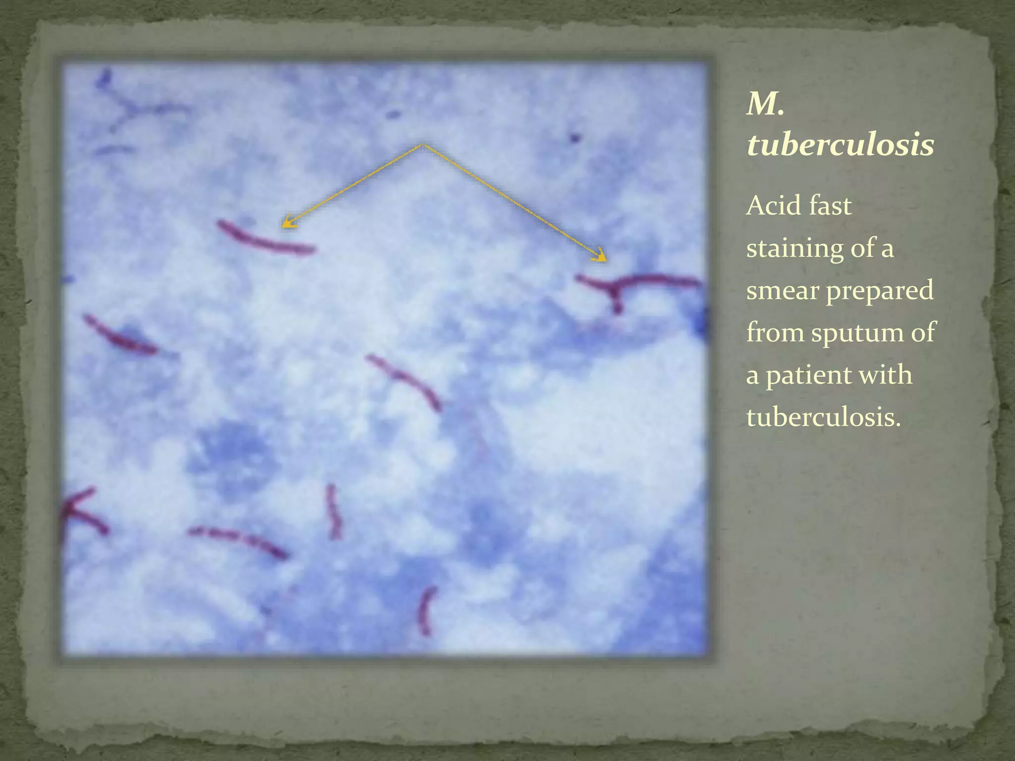 Tuberculosis- Oral Pathology | PPTX