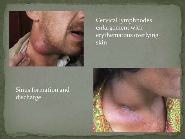 Tuberculosis- Oral Pathology