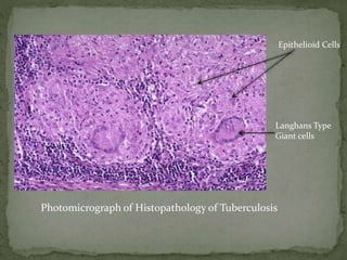 Tuberculosis Histology
