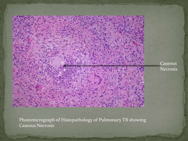Tuberculosis Oral Pathology
