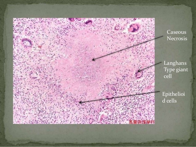 Tuberculosis Oral Pathology