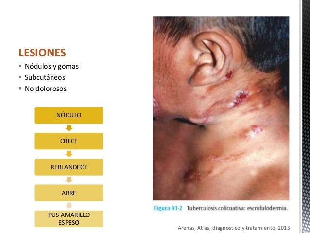 TUBERCULOSIS CUTANEA