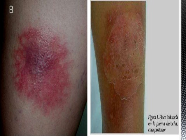 Lesoes Cutaneas Tuberculosas