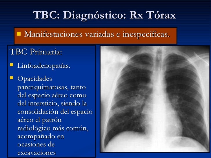 Tuberculosis Fisiopatologia, Diagnostico Y Tratamiento
